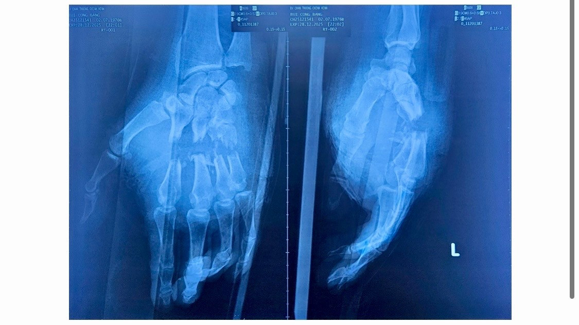 Hand saved for male worker after serious accident.